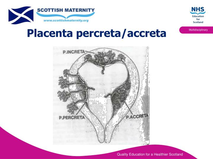PPT - Obstetric Haemorrhage PowerPoint Presentation - ID:5672984