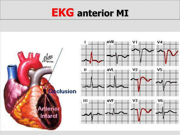 PPT - EKG PowerPoint Presentation - ID:5673221