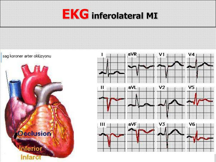 PPT - EKG PowerPoint Presentation - ID:5673221