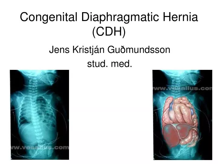 PPT - Congenital Diaphragmatic Hernia (CDH) PowerPoint Presentation ...