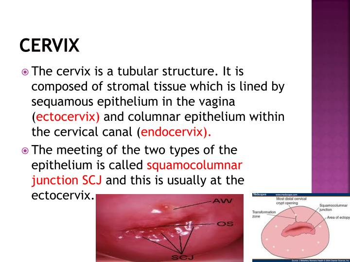 PPT - Premalignant conditions of the cervix PowerPoint Presentation ...