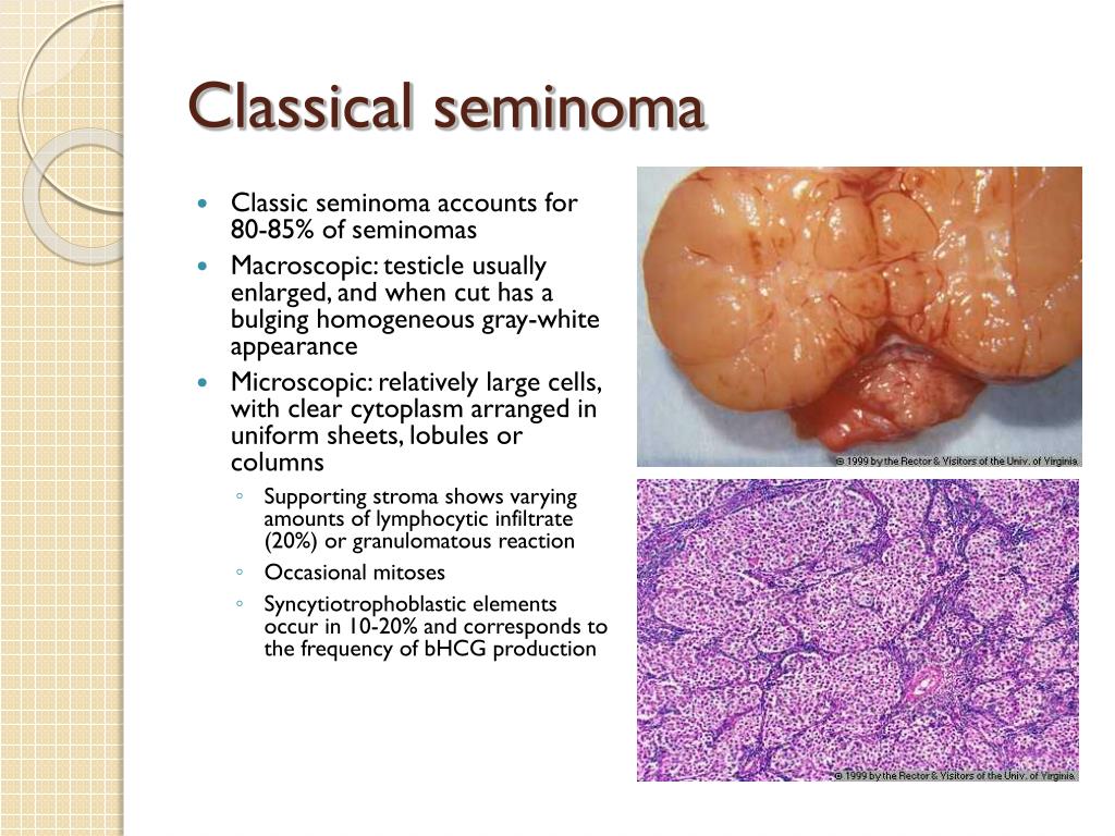 Ppt Testicular Malignancies Powerpoint Presentation Free Download