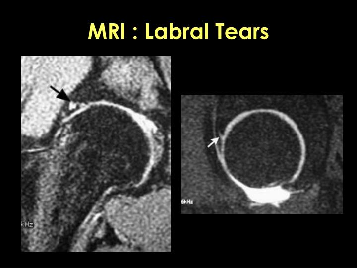 PPT - Application of Hip Arthroscopy PowerPoint Presentation - ID:5693076