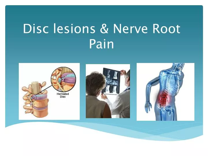 PPT - Disc lesions & Nerve Root Pain PowerPoint Presentation, free ...