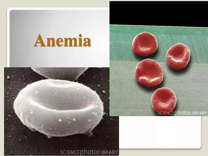 PPT - Anemia PowerPoint Presentation, free download - ID:5701423
