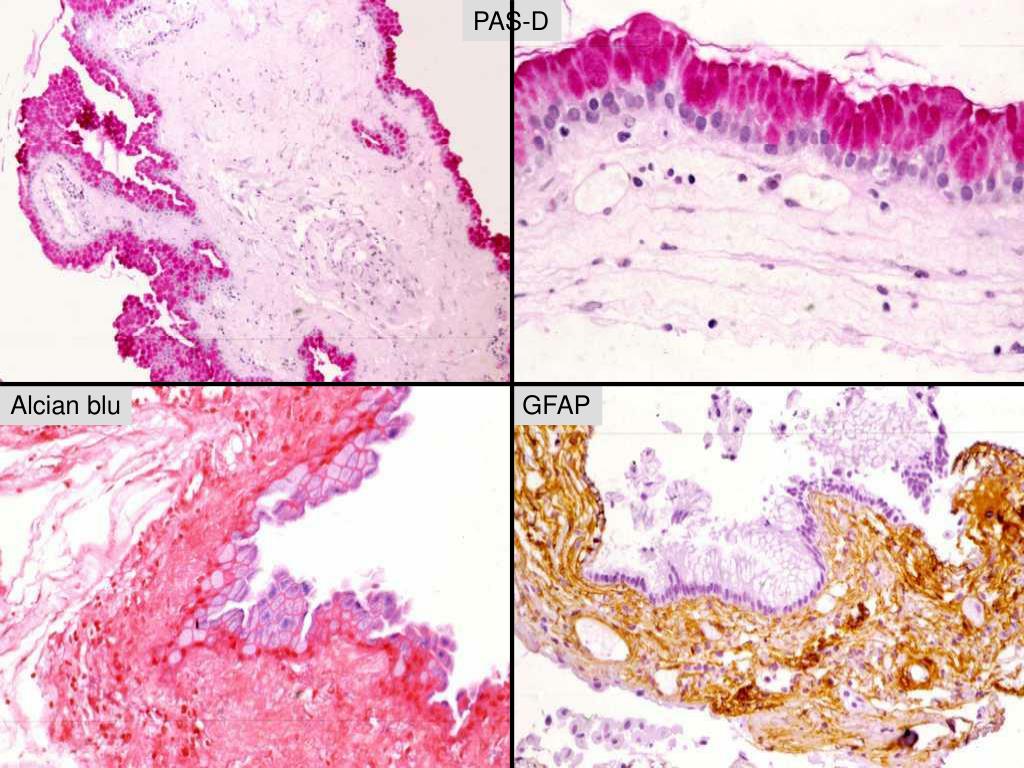 PPT - CISTI DISONTOGENETICA DI ORIGINE ENTODERMICA INTRACEREBRALE ...