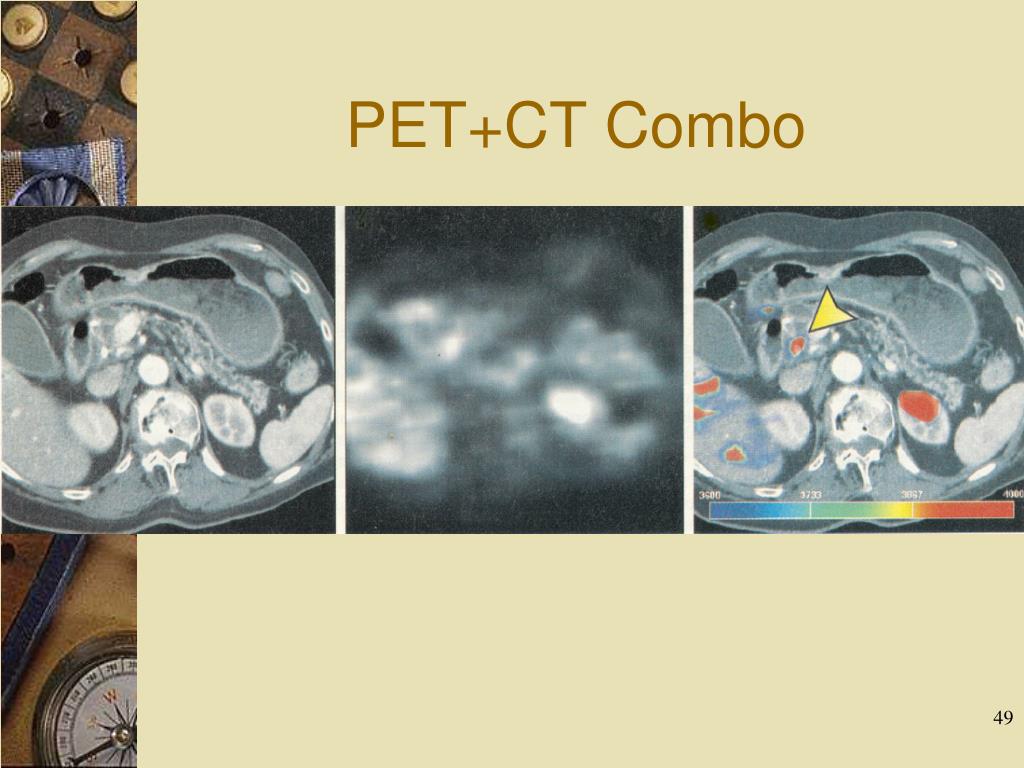 PPT - RECENT ADVANCES IN DIAGNOSIS AND MANAGEMENT OF EARLY GASTRIC ...