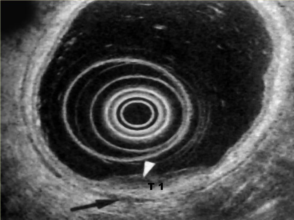 PPT - RECENT ADVANCES IN DIAGNOSIS AND MANAGEMENT OF EARLY GASTRIC ...