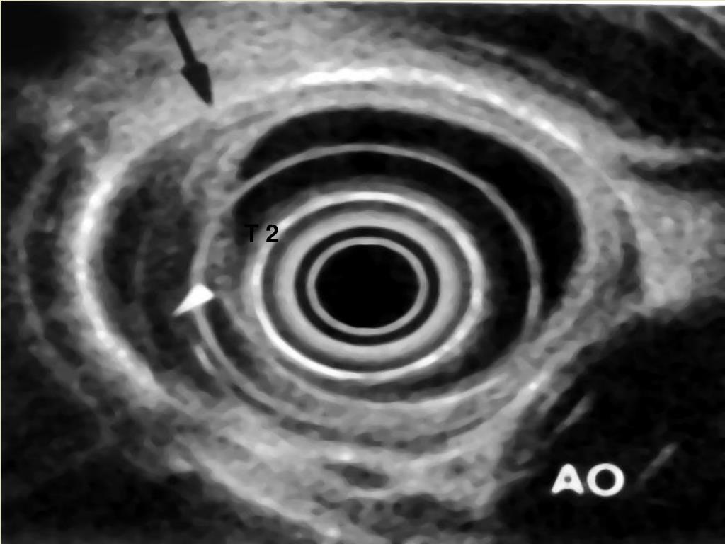 PPT - RECENT ADVANCES IN DIAGNOSIS AND MANAGEMENT OF EARLY GASTRIC ...