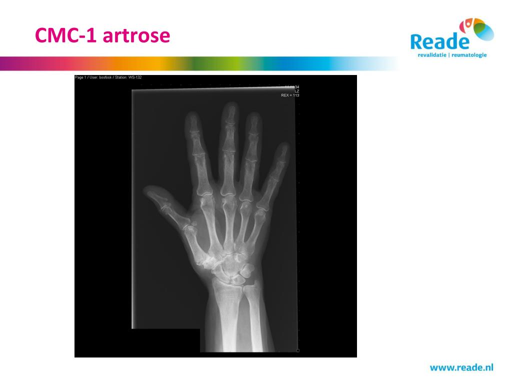 PPT - Handartrose in Vogelvlucht PowerPoint Presentation, free download ...