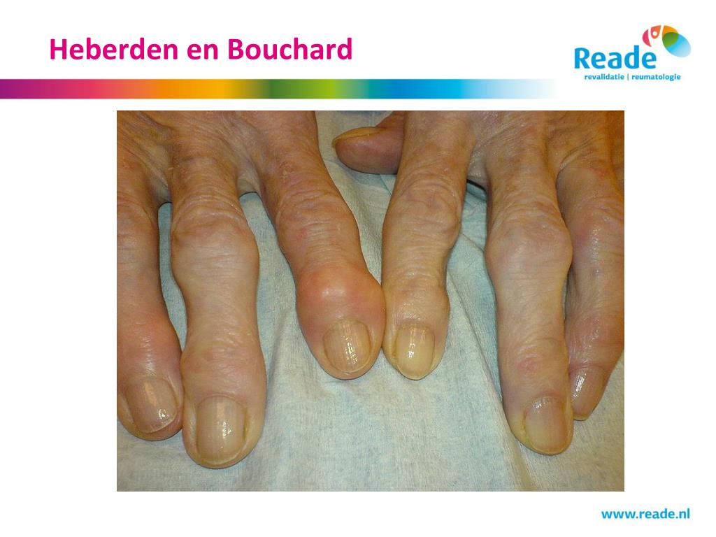 PPT - Handartrose in Vogelvlucht PowerPoint Presentation, free download ...