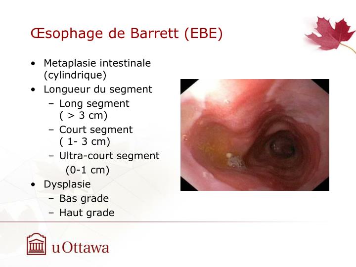 PPT - Conférence anatomo-clinique : Œsophage de Barrett, carcinome ...