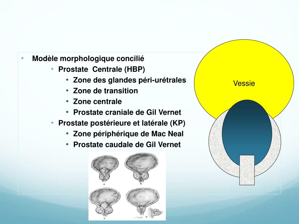 PPT - Aspects physiopathologiques de l’adénome prostatique PowerPoint ...