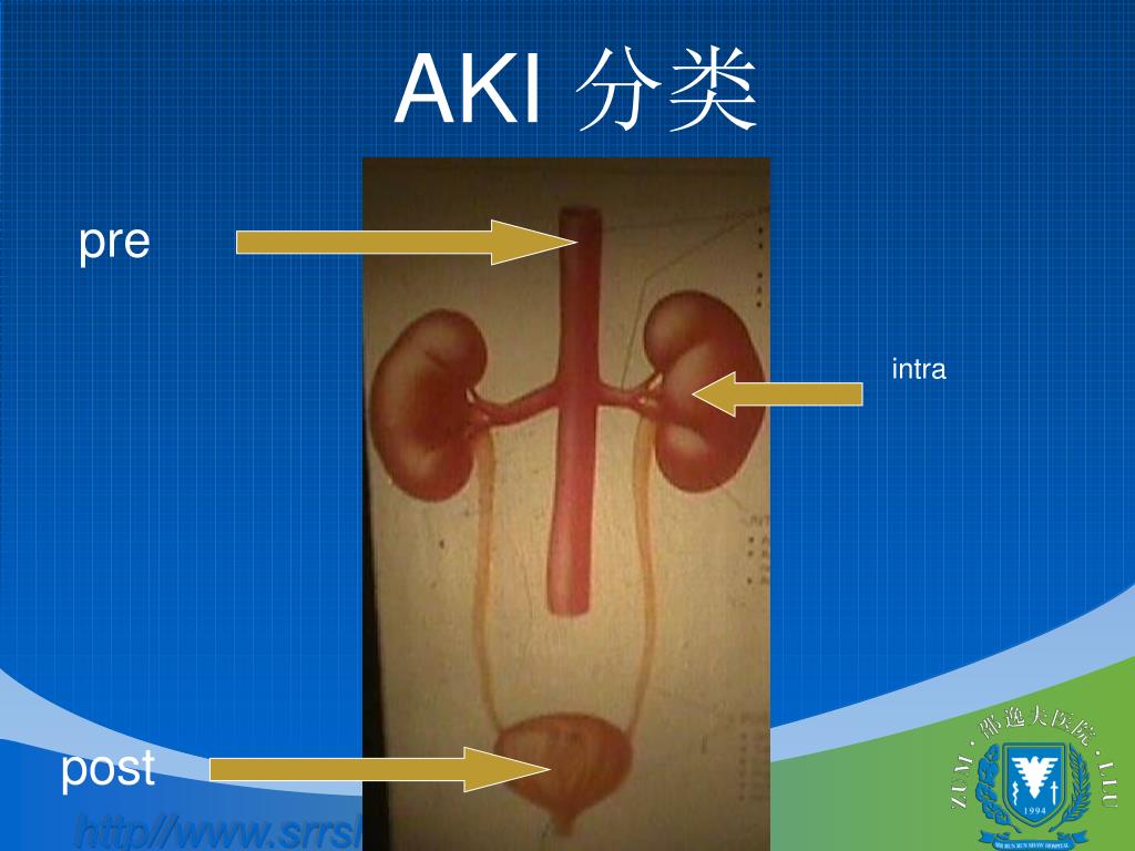 PPT - 急性肾损伤 Acute Kidney Injury (AKI) PowerPoint Presentation - ID:5725356