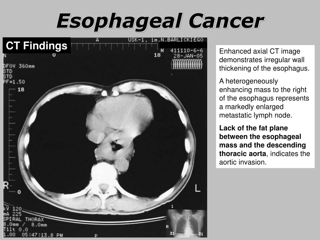 Ppt Esophageal Cancer Powerpoint Presentation Free Download Id 5735568