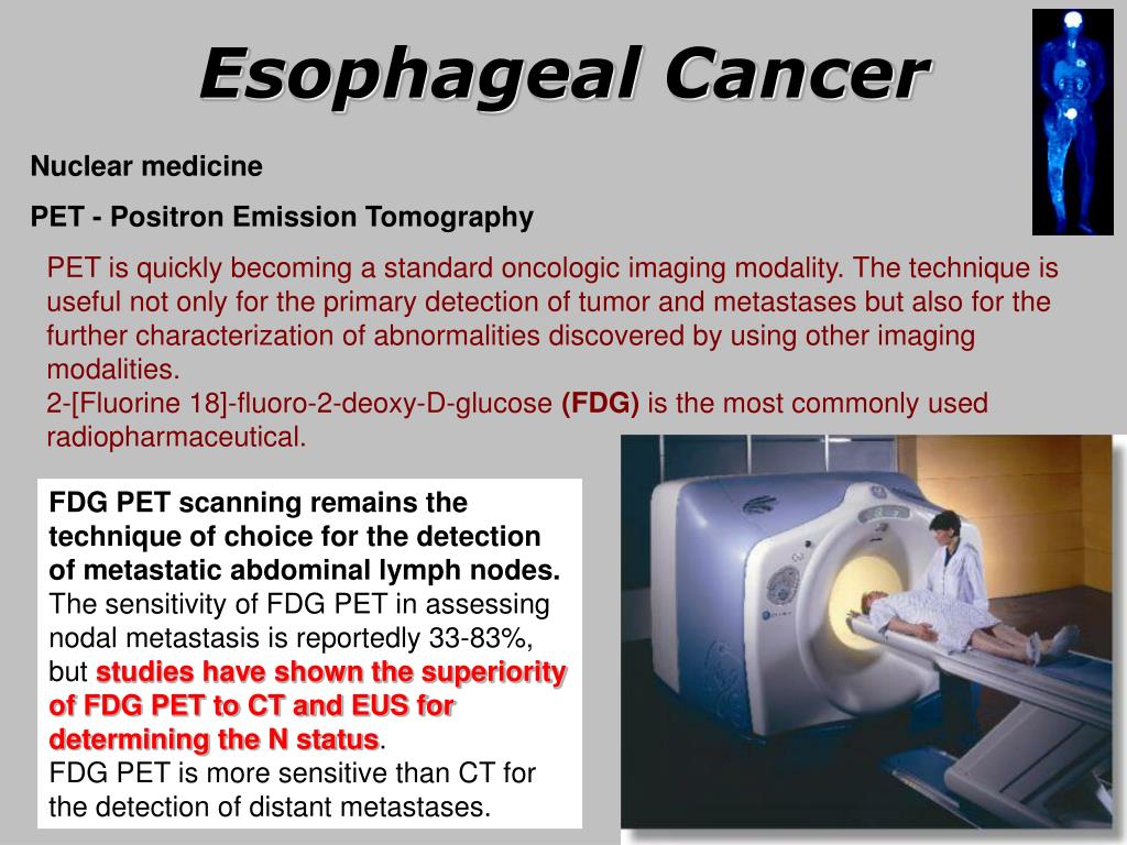 PPT - Esophageal Cancer PowerPoint Presentation, free download - ID:5735568