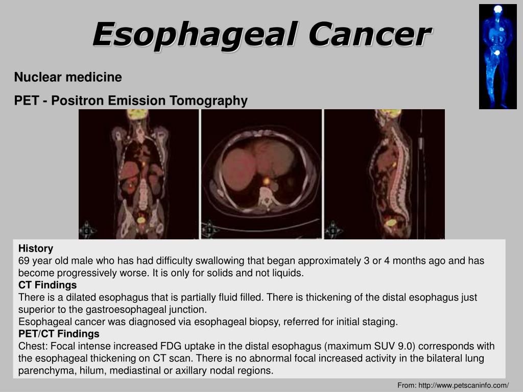 Ppt Esophageal Cancer Powerpoint Presentation Free Download Id 5735568