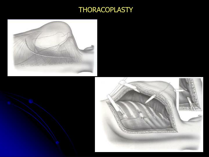 PPT - PLEURAL EMPYEMA PowerPoint Presentation - ID:5735694
