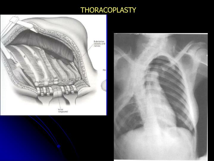 PPT - PLEURAL EMPYEMA PowerPoint Presentation - ID:5735694