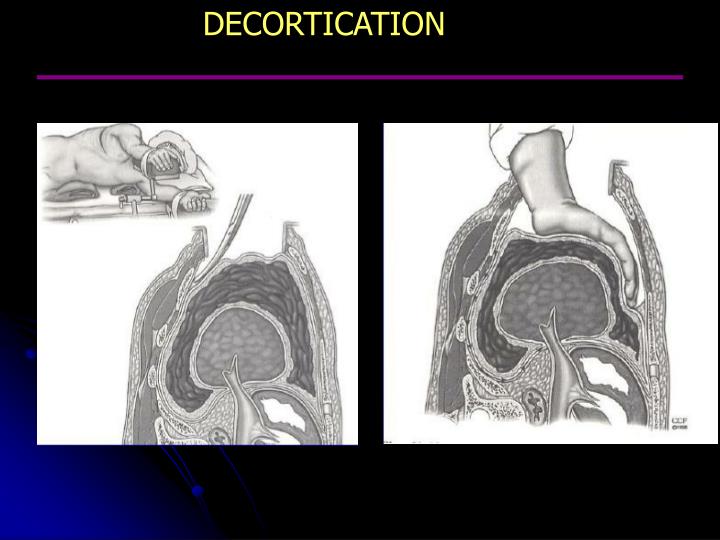 PPT - PLEURAL EMPYEMA PowerPoint Presentation - ID:5735694