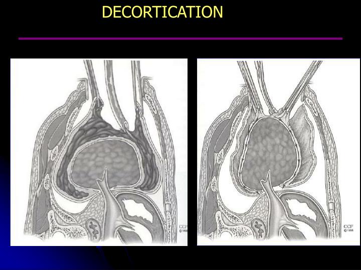 PPT - PLEURAL EMPYEMA PowerPoint Presentation - ID:5735694