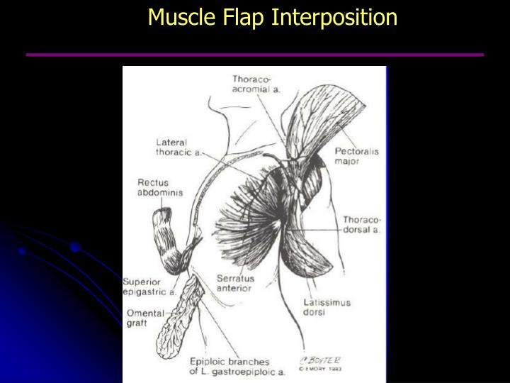 PPT - PLEURAL EMPYEMA PowerPoint Presentation - ID:5735694