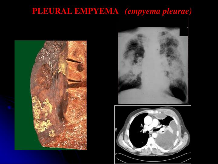 PPT - PLEURAL EMPYEMA PowerPoint Presentation - ID:5735694