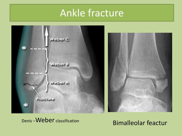 PPT - Common lower limb fracture PowerPoint Presentation - ID:5737068