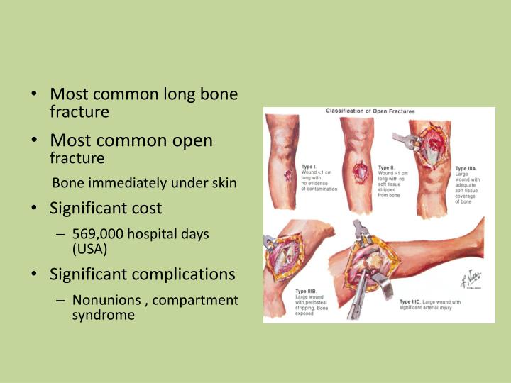 PPT - Common lower limb fracture PowerPoint Presentation - ID:5737068