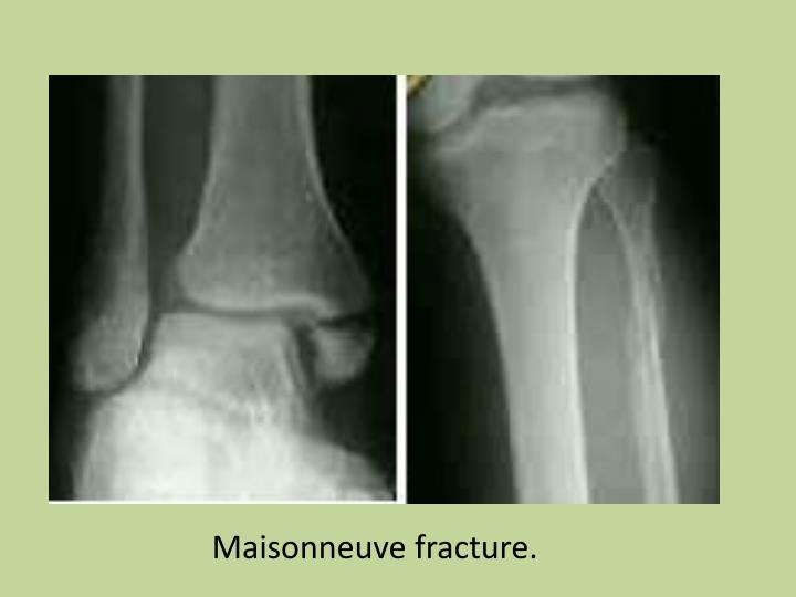 PPT - Common lower limb fracture PowerPoint Presentation - ID:5737068