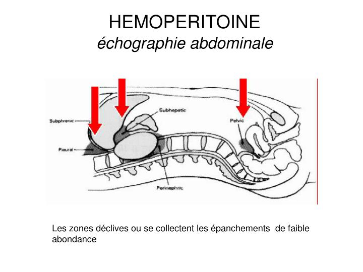 PPT - Hémorragies digestives Hémopéritoine PowerPoint Presentation - ID ...