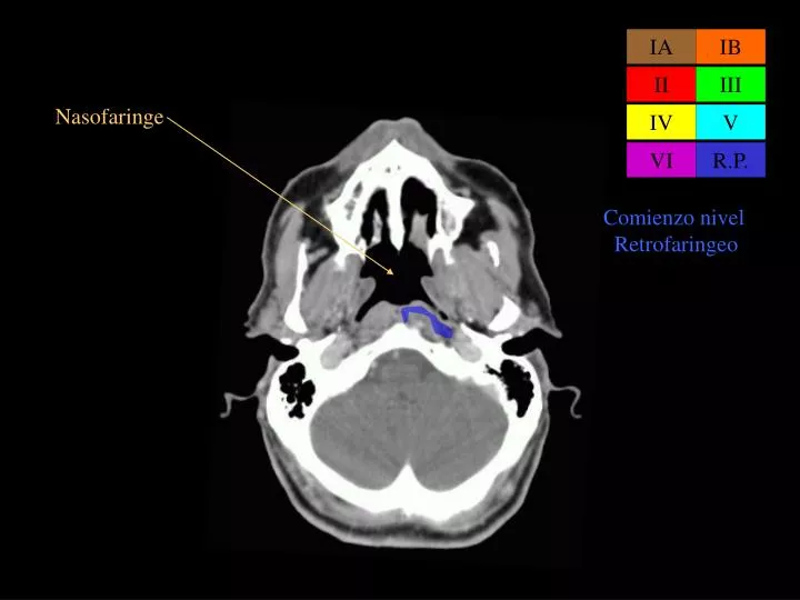 PPT - Nasofaringe PowerPoint Presentation, free download - ID:5742272