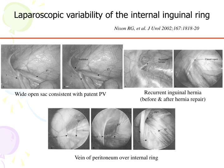 PPT - Surgical Treatment of Hydrocele & Hernia PowerPoint Presentation ...