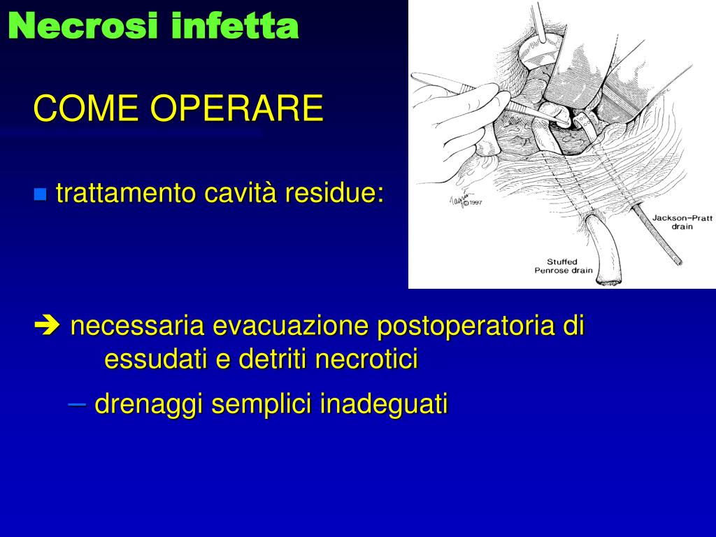 PPT - La pancreatite acuta: aggiornamenti terapeutici PowerPoint ...