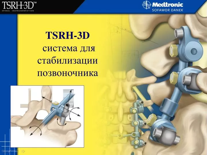 PPT - TSRH-3D система для стабилизации позвоночника PowerPoint ...