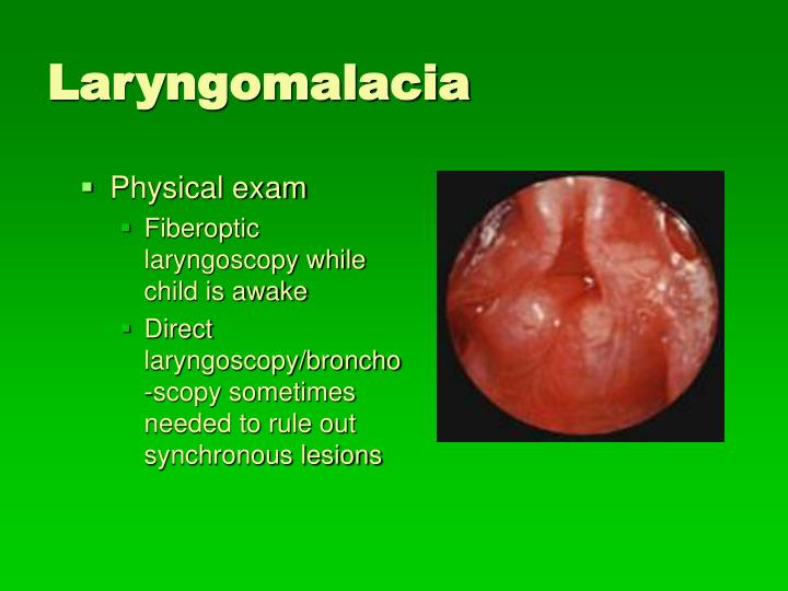 PPT - Stridor in Child PowerPoint Presentation - ID:5754177
