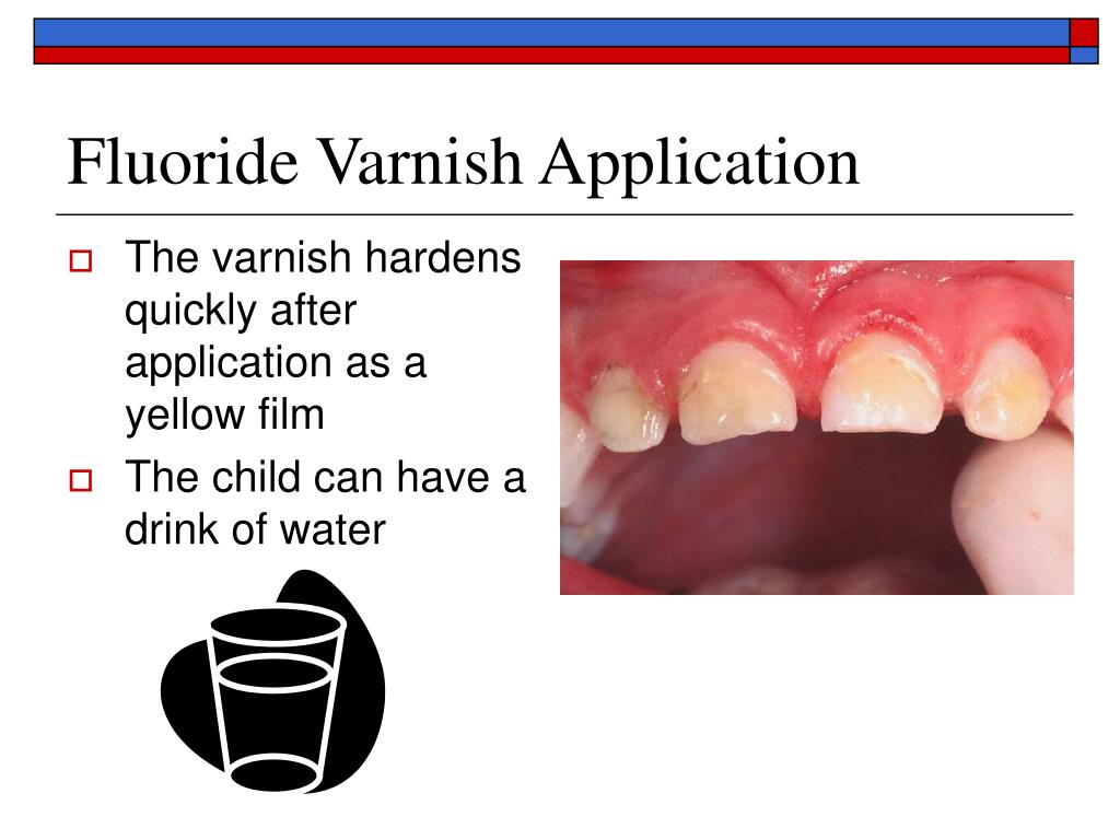 PPT - Fluoride Varnish Application PowerPoint Presentation, free ... PPT - Fluoride Varnish Application PowerPoint Presentation, free ...