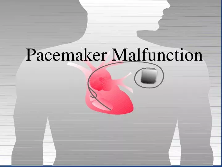 PPT - Pacemaker Malfunction PowerPoint Presentation, free download - ID ...