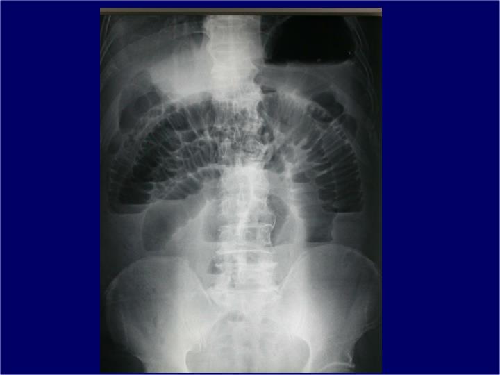 PPT - Intestinal Obstuction PowerPoint Presentation - ID:5775265