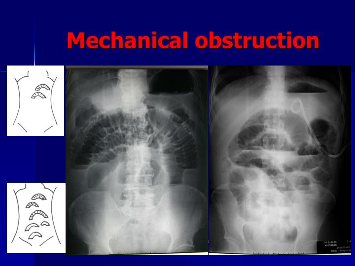 PPT - Intestinal Obstuction PowerPoint Presentation - ID:5775265