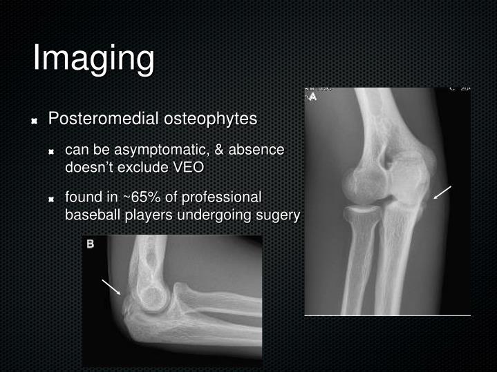 PPT - Medial Elbow Instability PowerPoint Presentation - ID:5784131