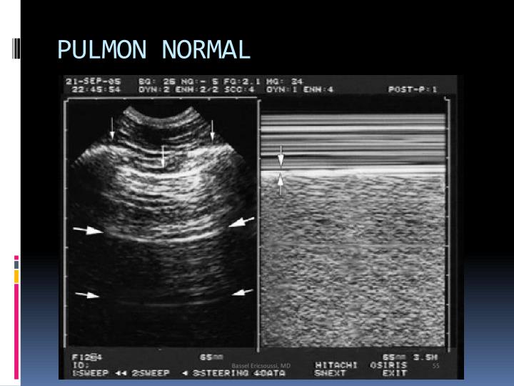 PPT - ECOGRAFIA PULMONAR PowerPoint Presentation - ID:5786344