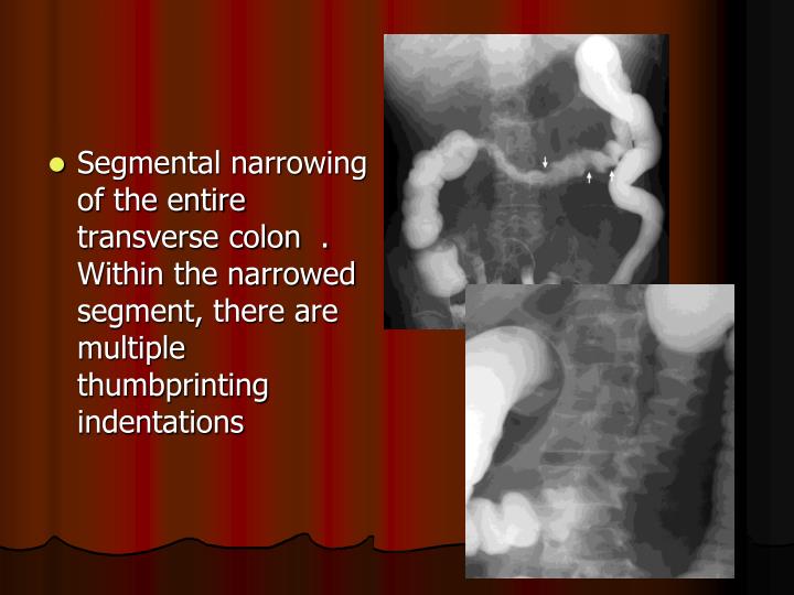 PPT - Bowel Ischemia PowerPoint Presentation - ID:5787723