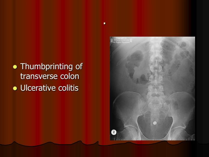 PPT - Bowel Ischemia PowerPoint Presentation - ID:5787723