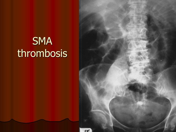 PPT - Bowel Ischemia PowerPoint Presentation - ID:5787723