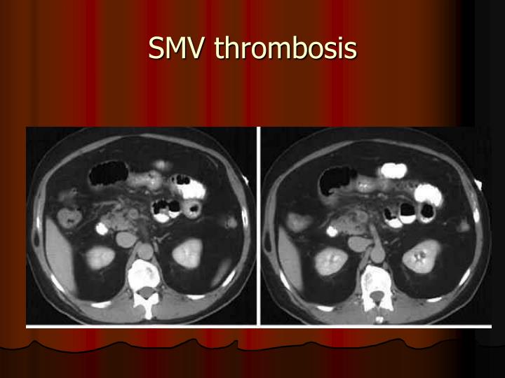 PPT - Bowel Ischemia PowerPoint Presentation - ID:5787723