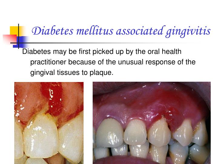 PPT - Pre-clinical Periodontics PowerPoint Presentation - ID:5789235