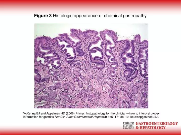 PPT - Figure 3 Histologic appearance of chemical gastropathy PowerPoint ...