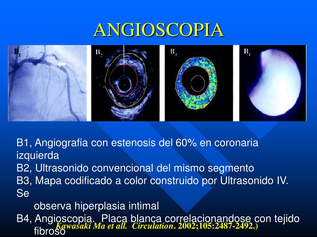 PPT - IMAGEN DE PLACAS ATEROTROMBOTICAS PowerPoint Presentation, free ...