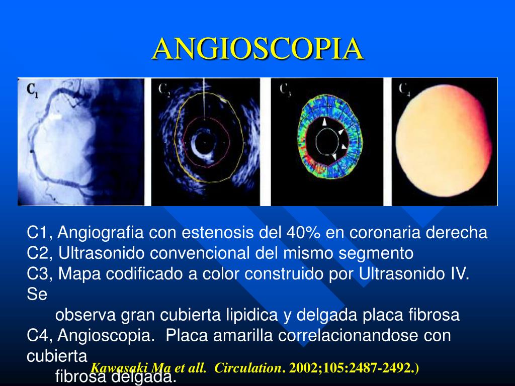 PPT - IMAGEN DE PLACAS ATEROTROMBOTICAS PowerPoint Presentation, free ...